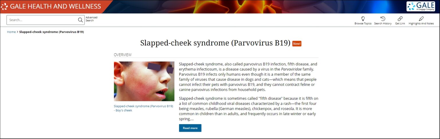 Slapped-Cheek Syndrome